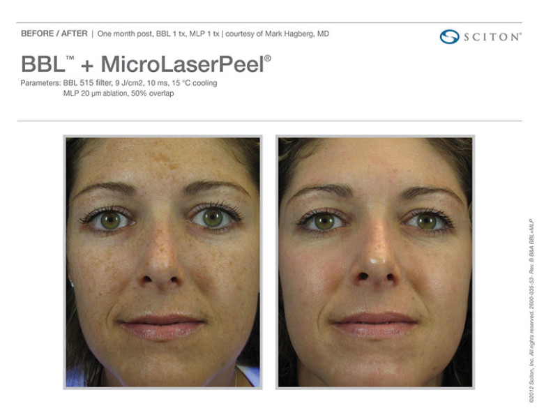 Laser Skin Resurfacing Bergen County, NJ | Medical Spa
