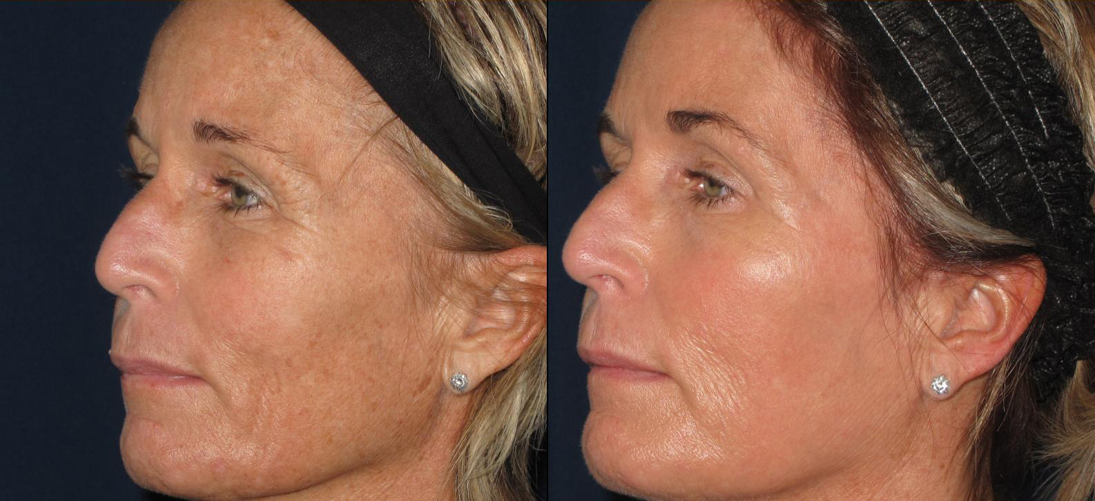 Photofacial - Elizabeth Roche