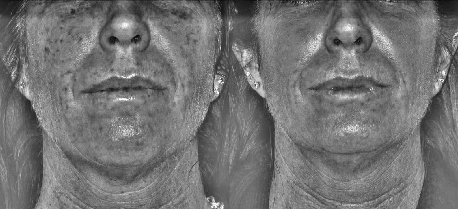 Photofacial - Elizabeth Roche