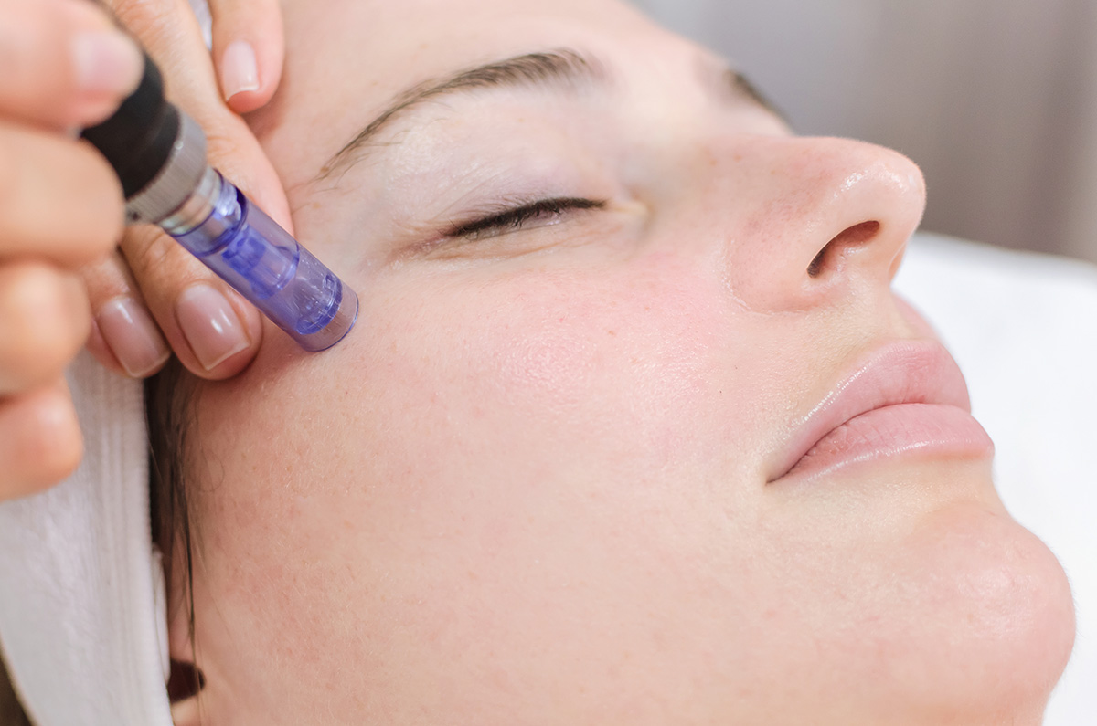 What Your Esthetician Wants You to Know About Microneedling | Elizabeth ...