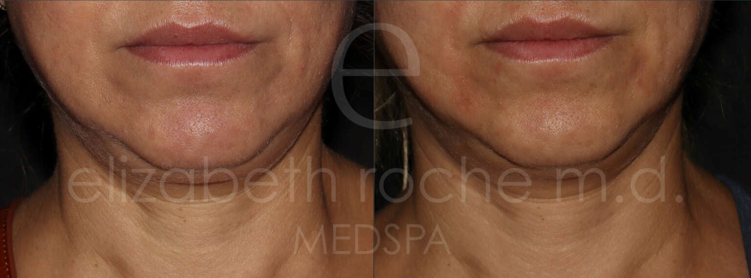 SculpSure - Elizabeth Roche